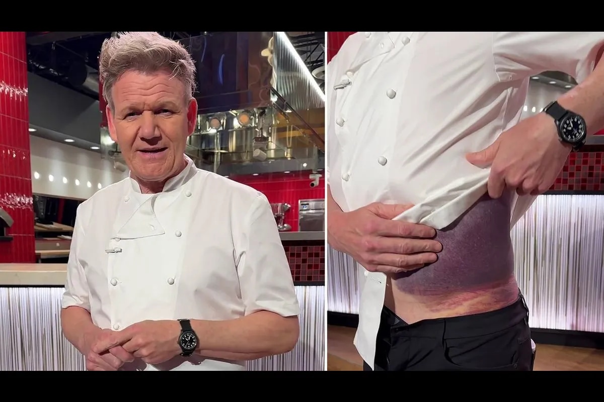 Gordon Ramsay shows severe bruise after getting into cycling accident ...