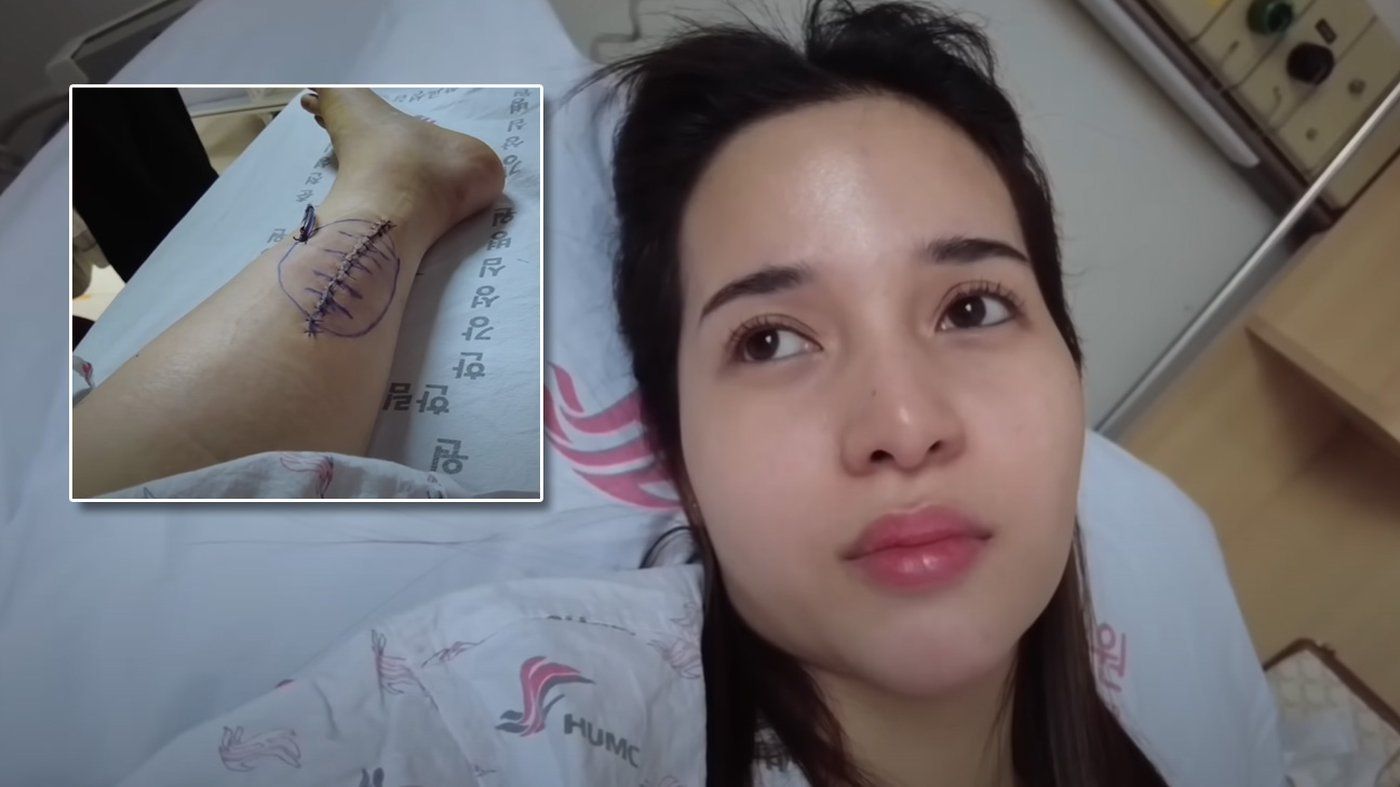 Kristel Fulgar undergoes surgery in Korea for leg tumor | ABS-CBN ...