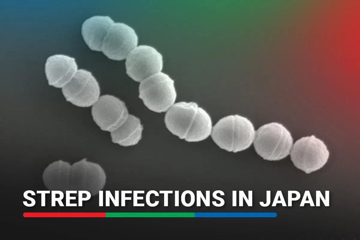 Potentially deadly strep infections rise in Japan but expert says ...