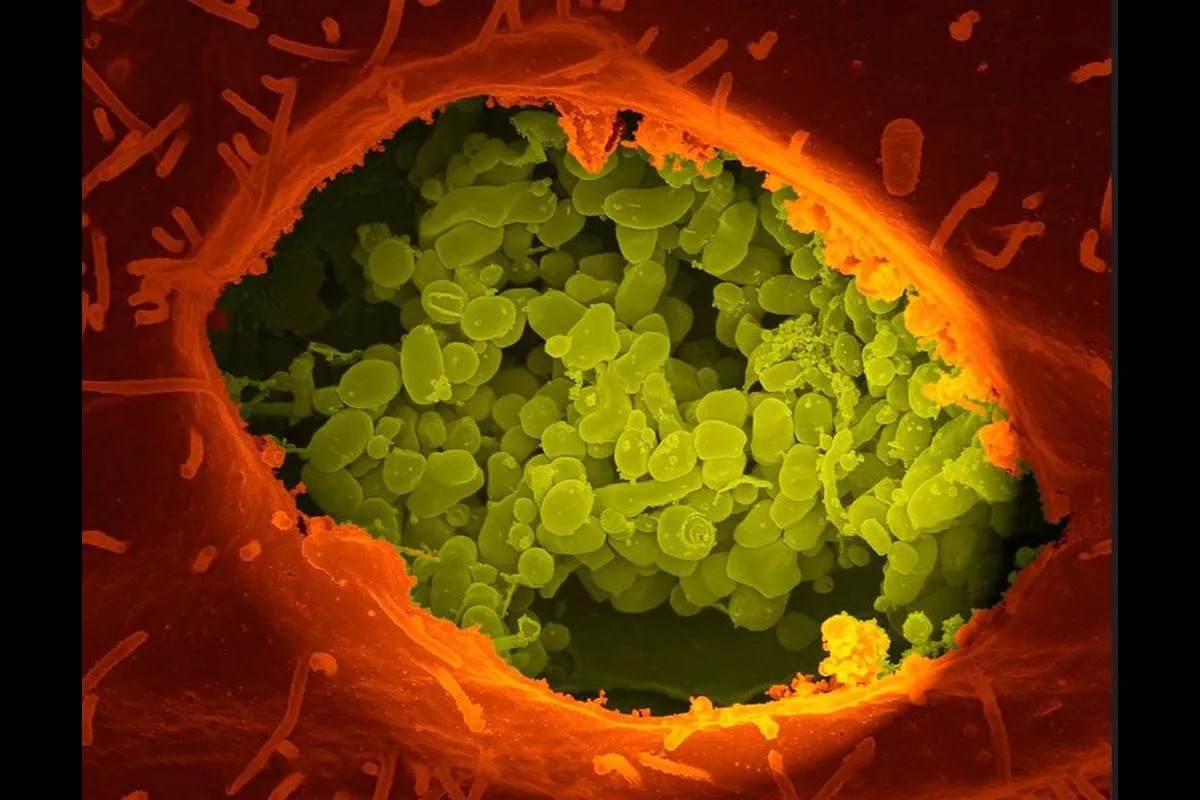 Philippines confirms first case of Q fever | ABS-CBN News