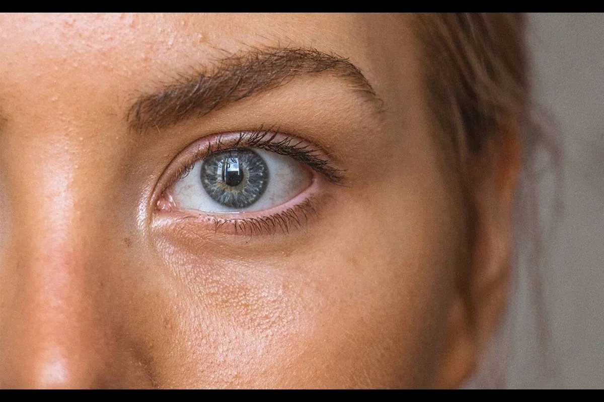 Dark Circles? Crows Feet? Fillers Can Erase Them Instantly | ABS-CBN ...