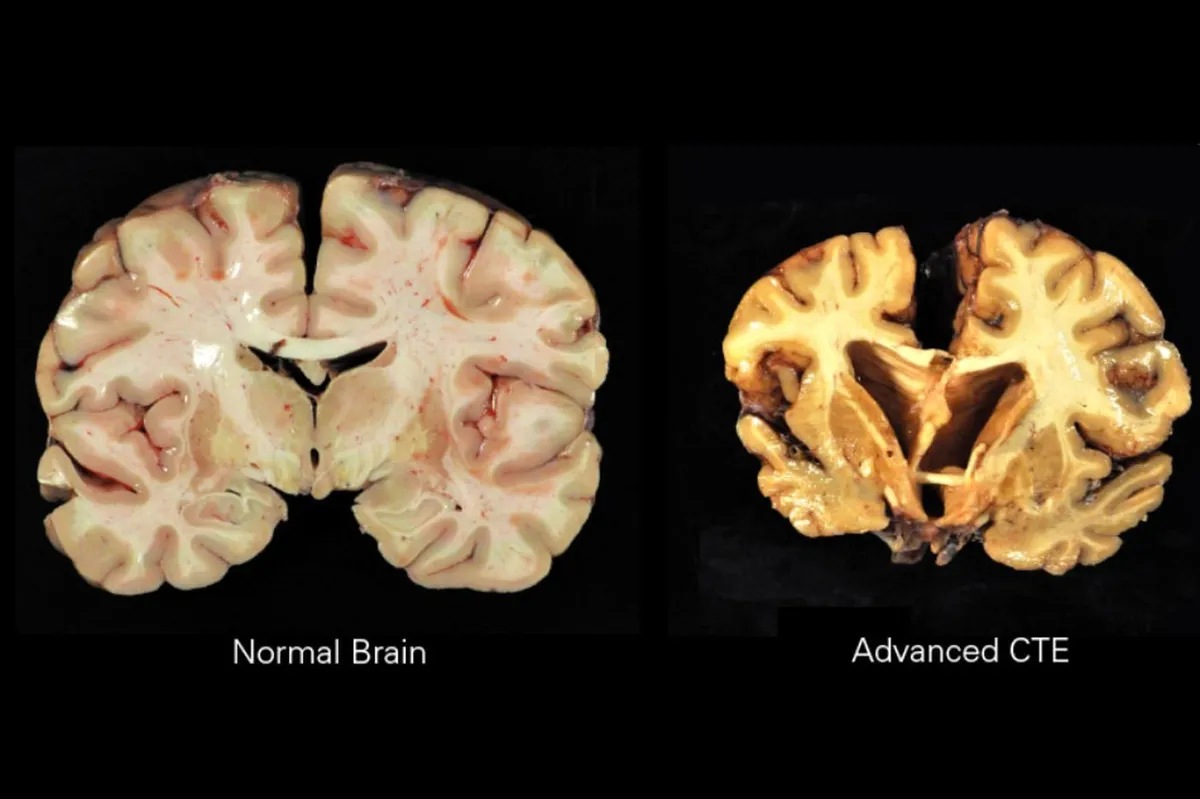First known CTE brain disease diagnosis for a female athlete | ABS-CBN ...