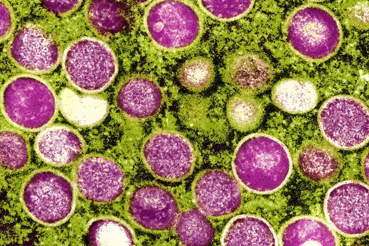 PH second monkeypox patient 'completely healed,' discharged from ...