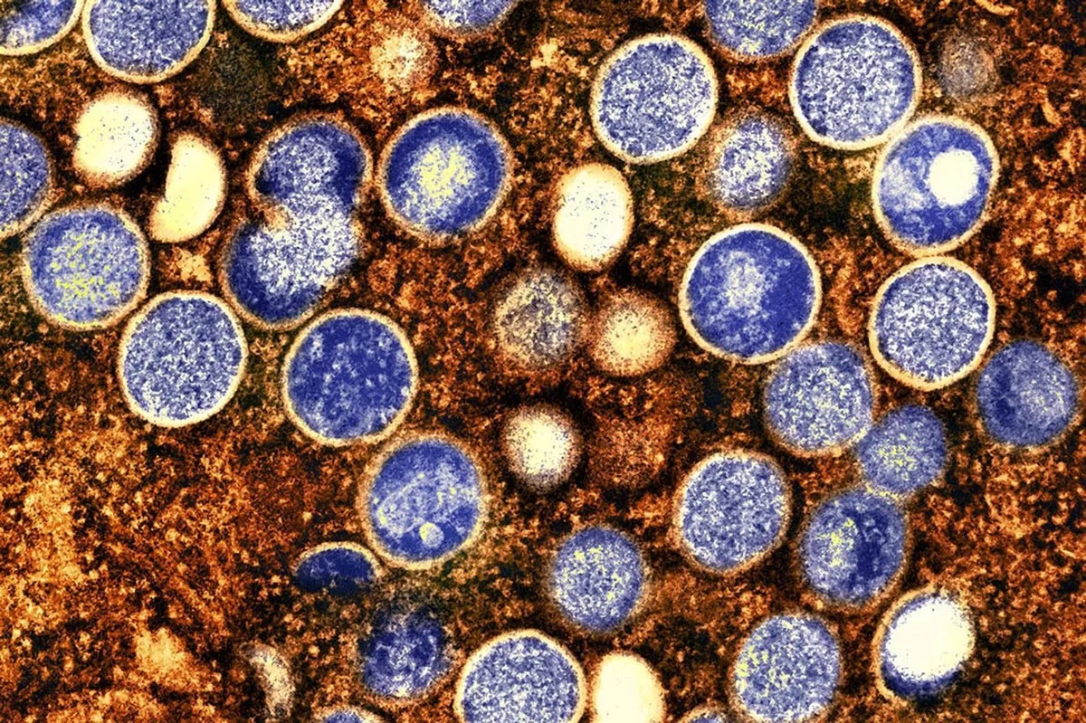 DOH: 3rd, 4th monkeypox cases recovering; contacts asymptomatic after ...