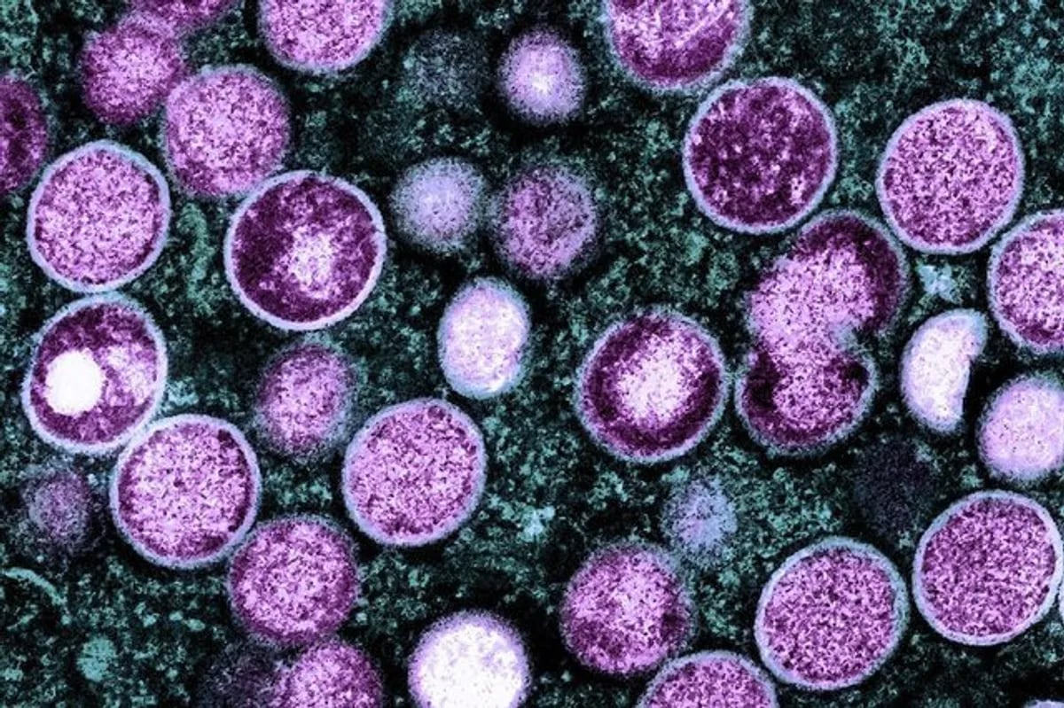 DOH probes unauthorized release of monkeypox patient's photos | ABS-CBN ...