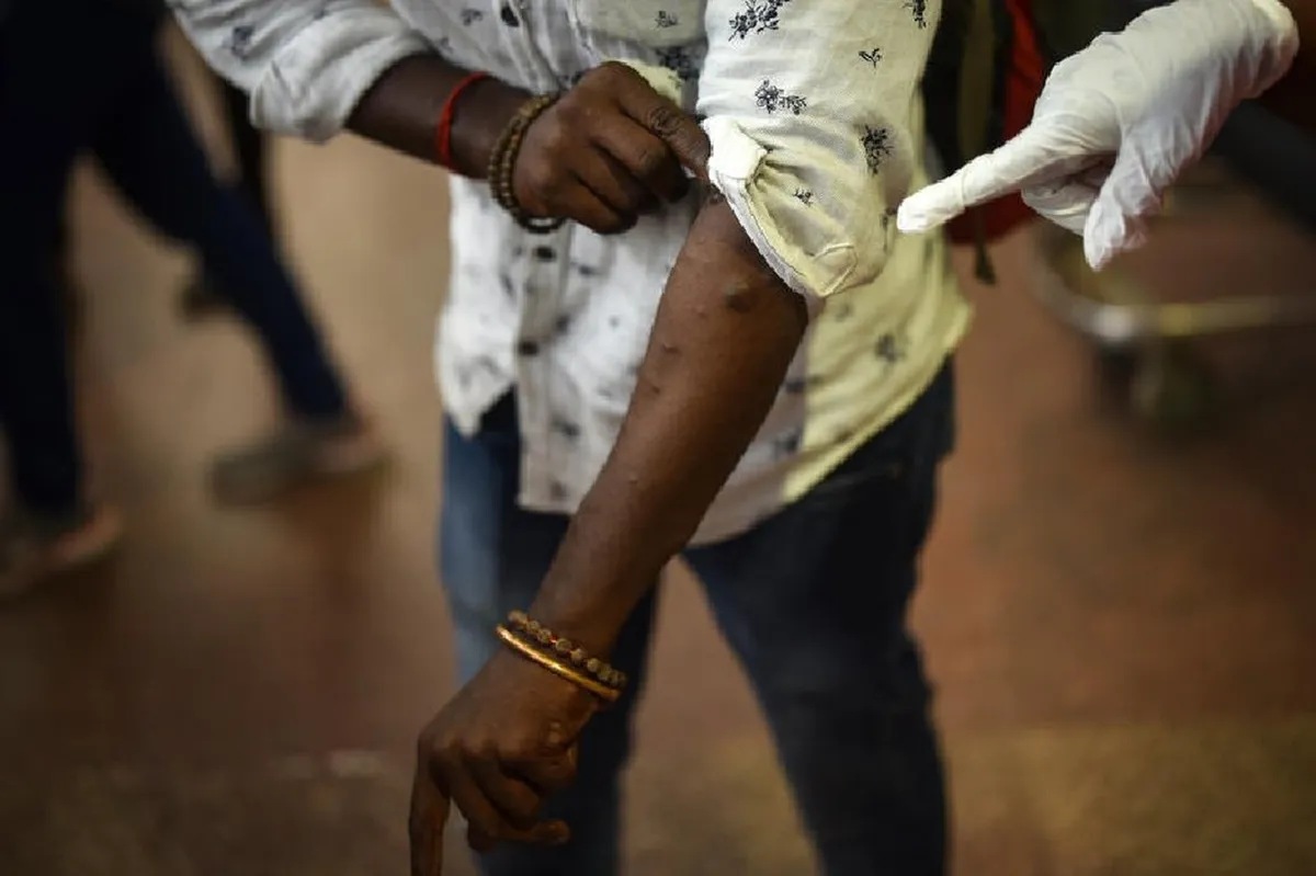 'Crying all the time': Monkeypox patients reveal psychological scars ...