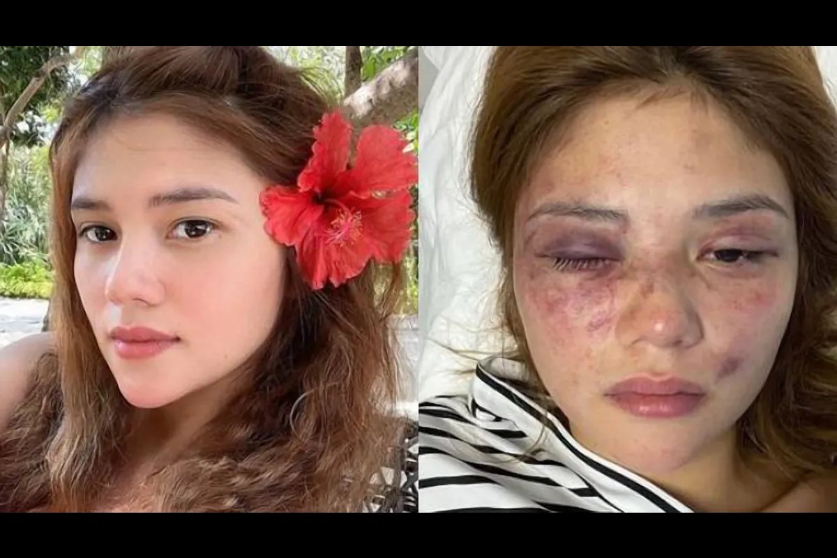 Kit Thompson’s girlfriend shares photo of battered face: ‘You all ...