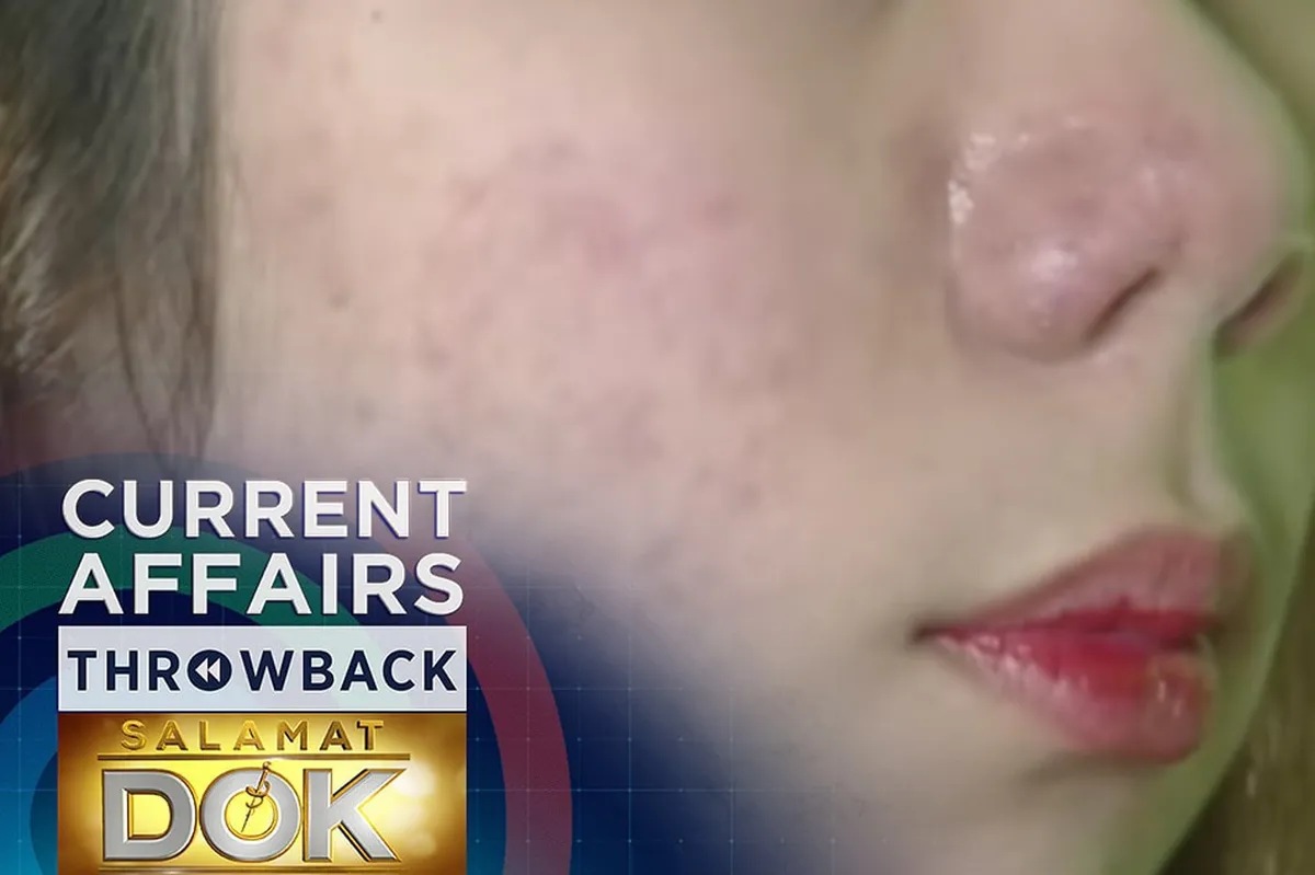 THROWBACK: Complications of acne | ABS-CBN Lifestyle