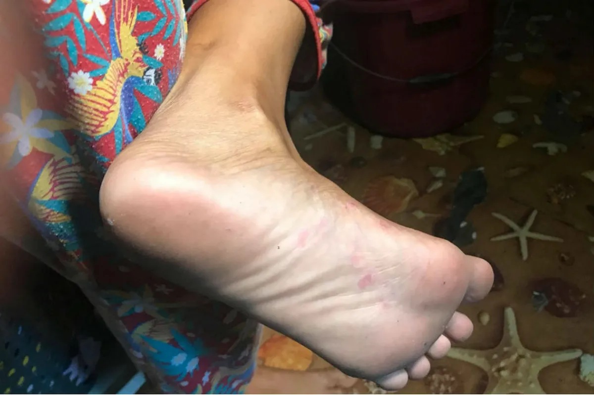 Alipunga outbreak idineklara sa 2 bayan sa Pampanga | ABS-CBN News