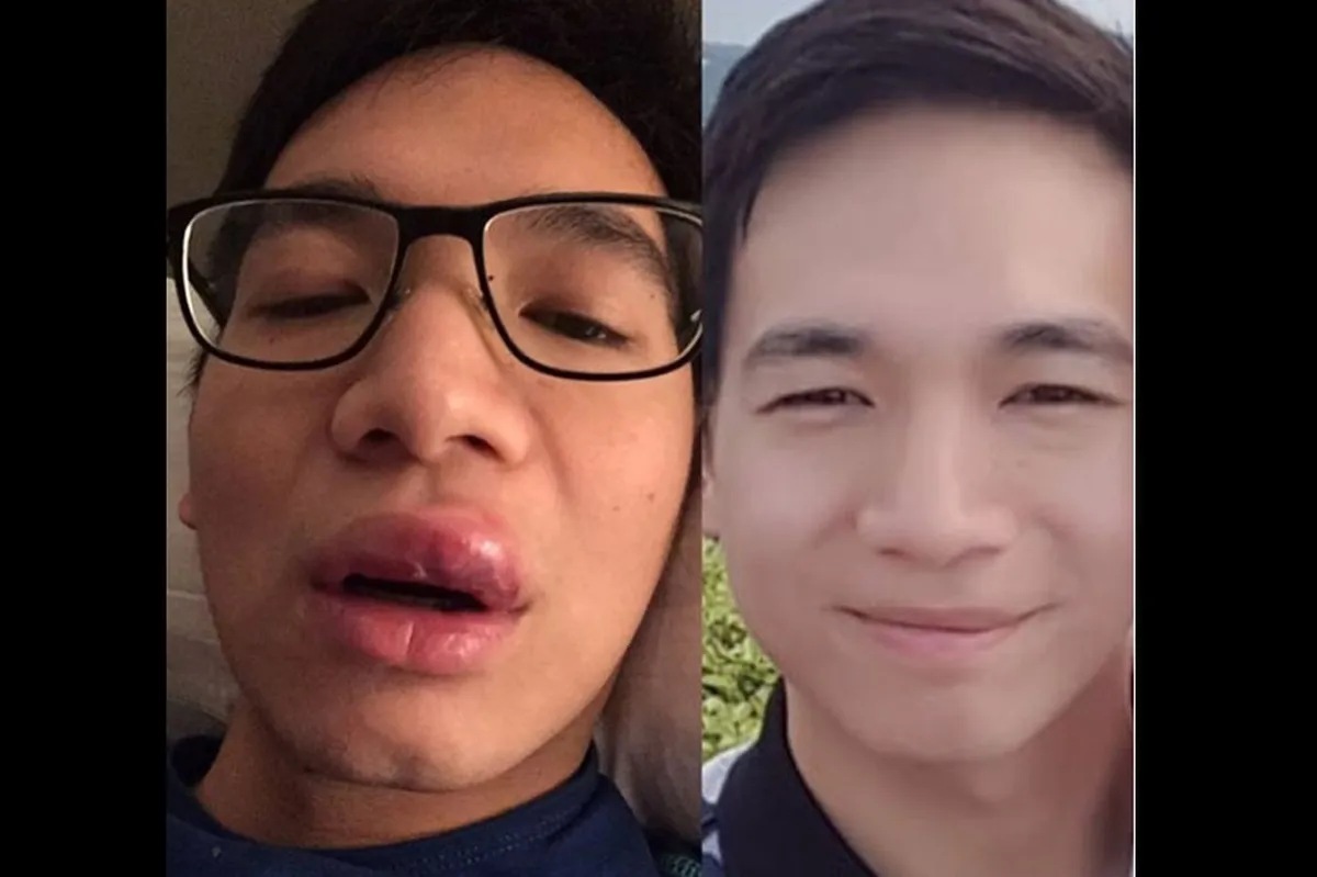 PBA: Chris Tiu ibinahagi ang retrato ng magang labi — ‘I was really lucky’ | ABS-CBN Sports