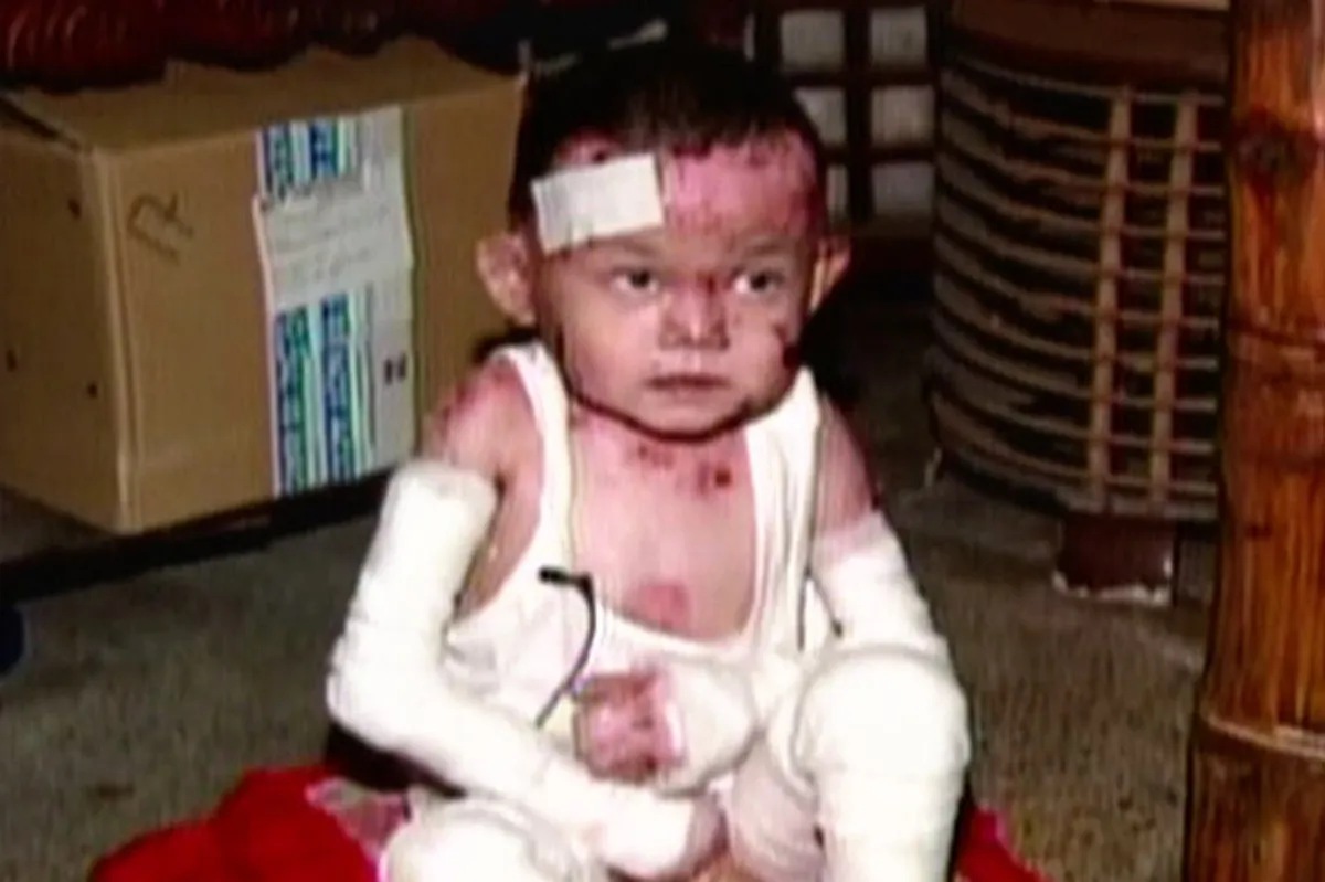 Parang paru-paro: Batang may butterfly disease, nangangailangan ng ...