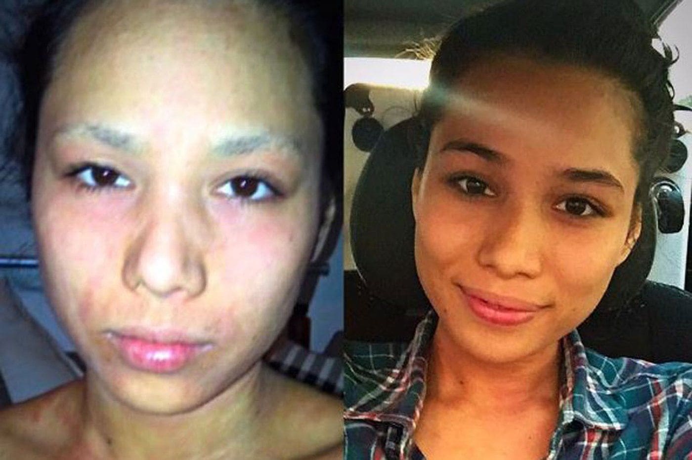 How Bb. Pilipinas winner battled and overcame painful skin condition ...