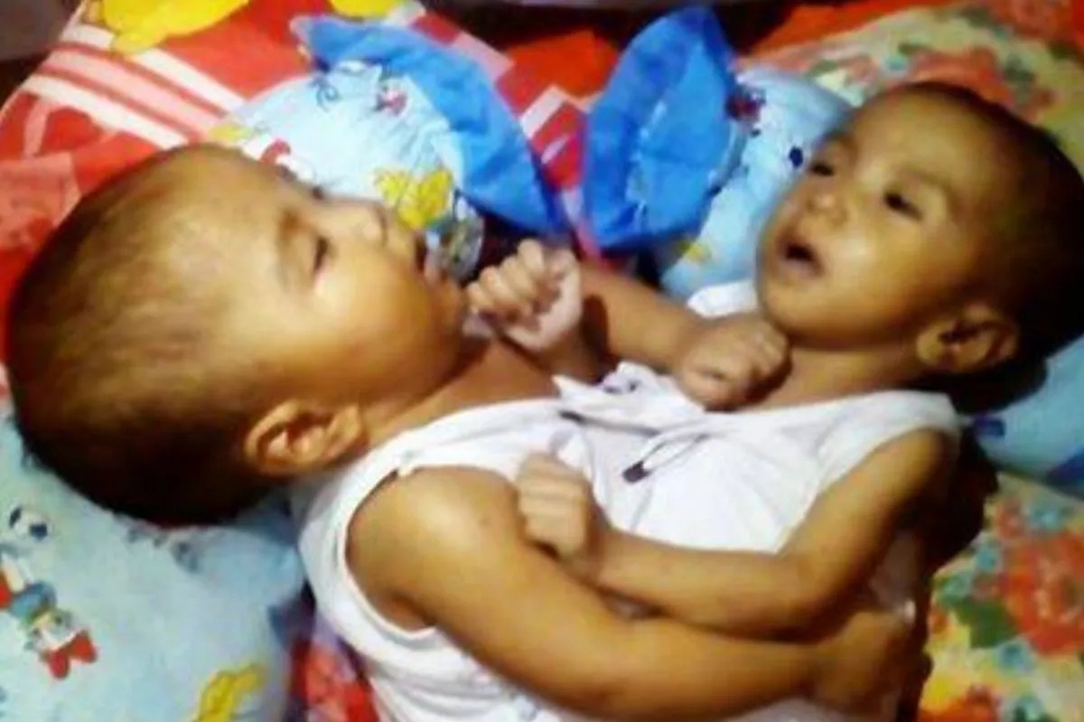 Conjoined twins sa Isabela, pumanaw na | ABS-CBN News
