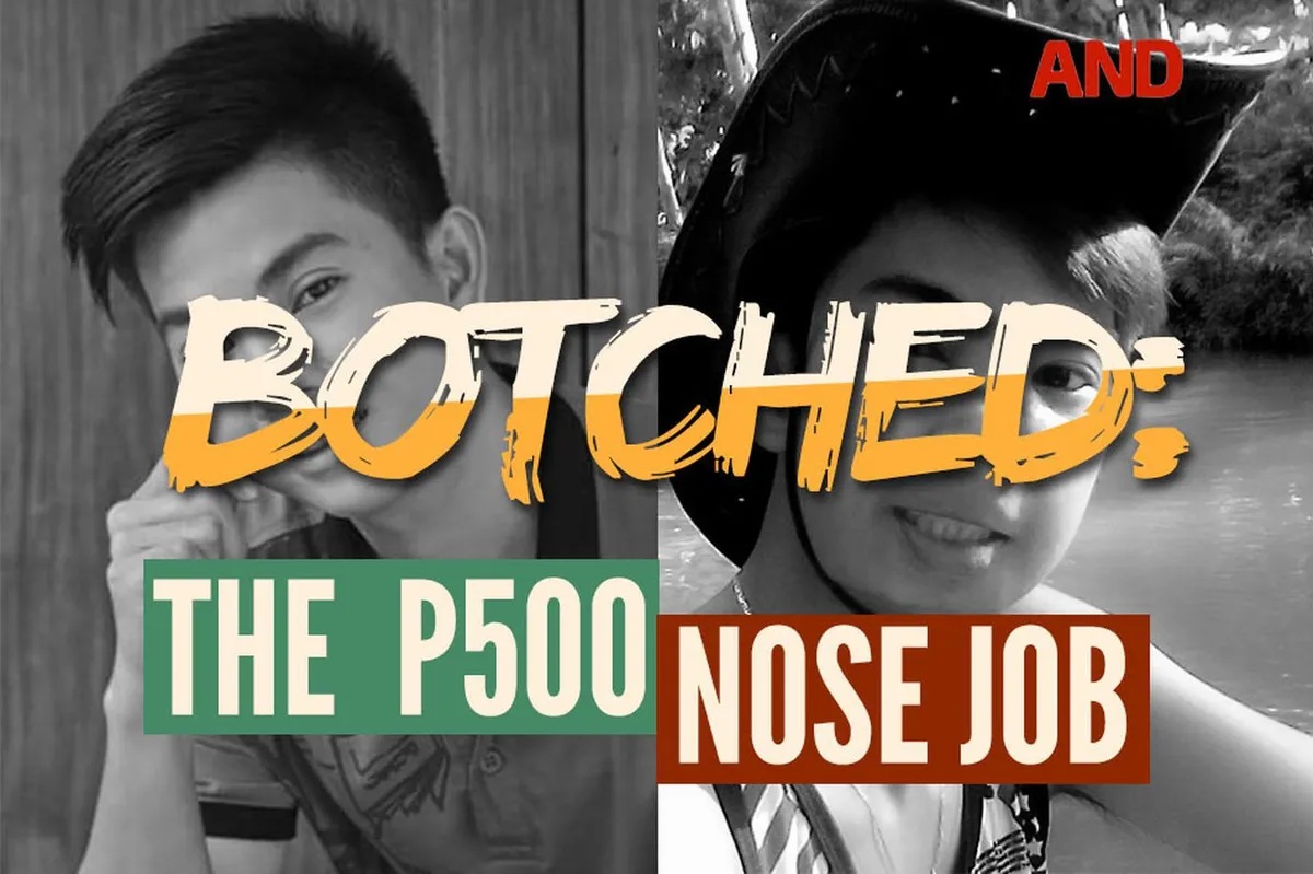 Botched: The P500 nose job | ABS-CBN Lifestyle