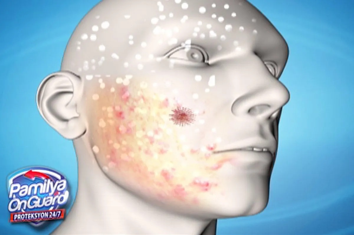 Excessive sweating may cause acne | ABS-CBN Lifestyle