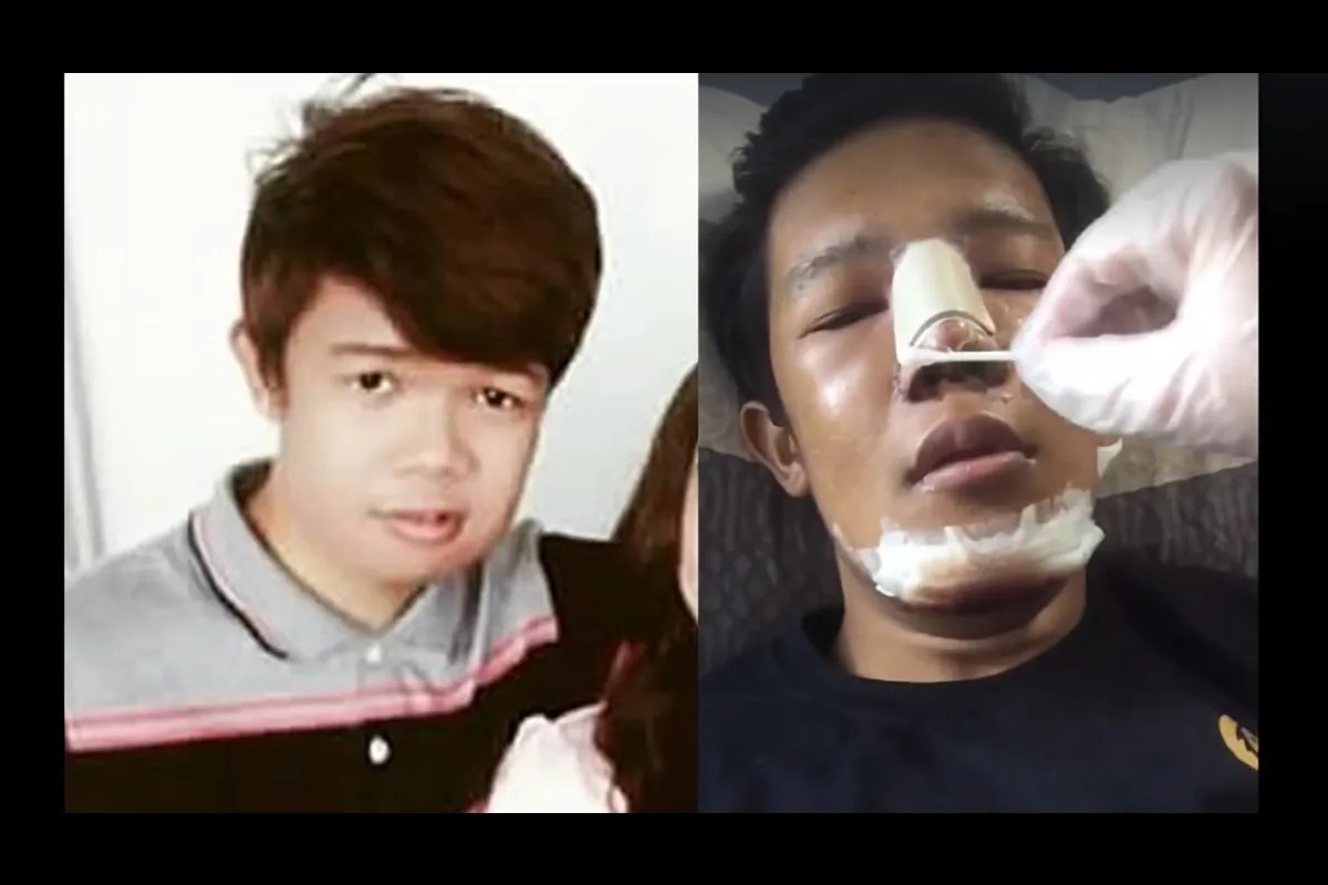 Ano na nga ba ang itsura ni Marlou Arizala matapos ang kanyang pagpaparetoke ng mukha? | ABS-CBN ...