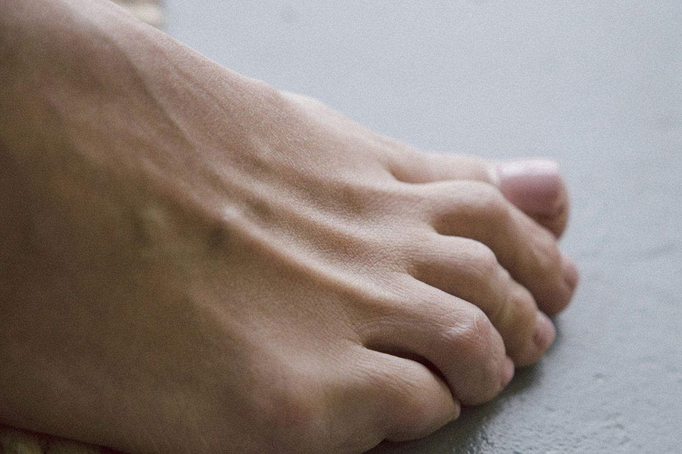 Mga maling paniniwala sa gout na dapat puksain | ABS-CBN News