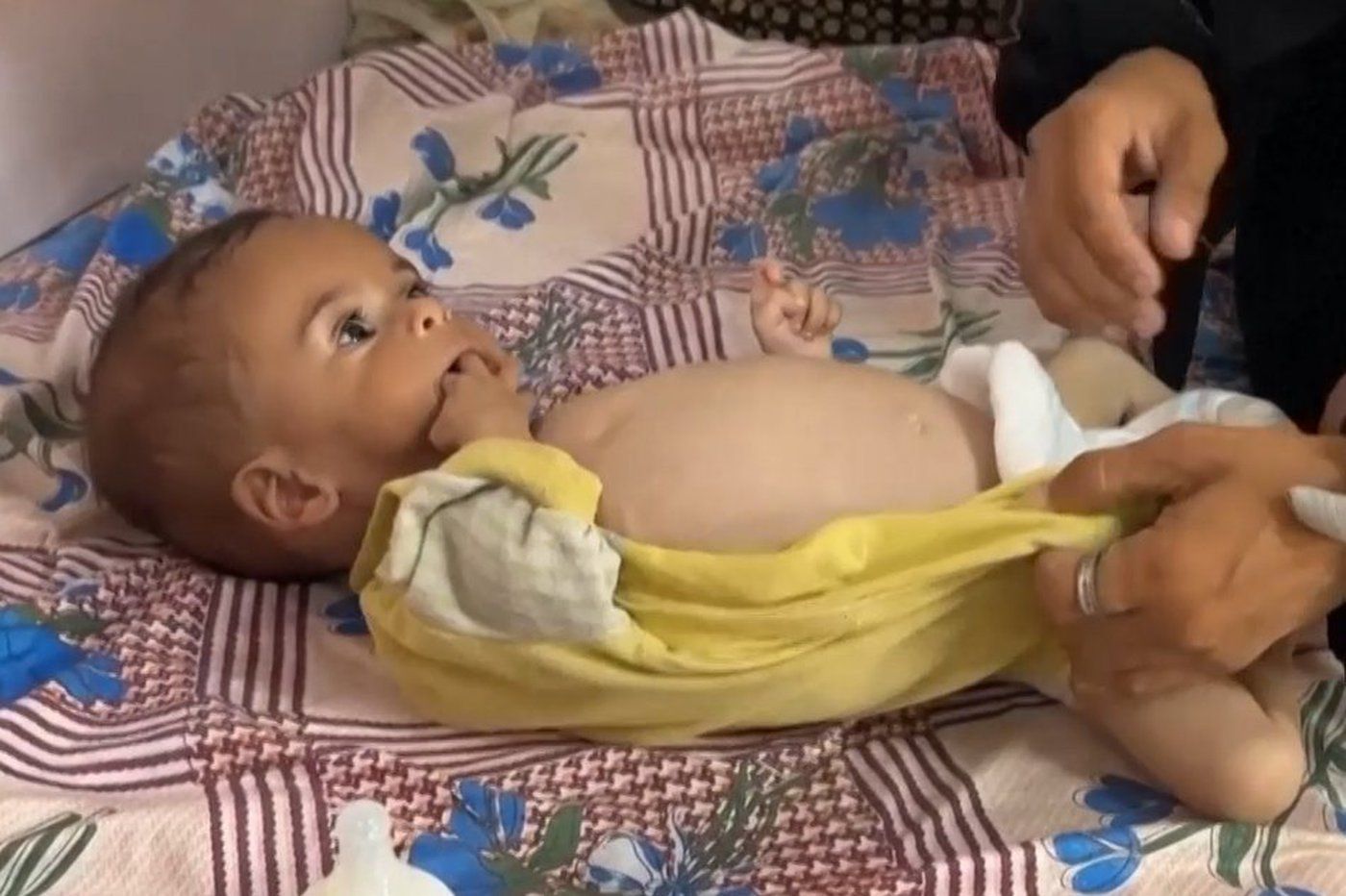 'She doesn't grow': Palestinian mother shares plight of malnourished ...